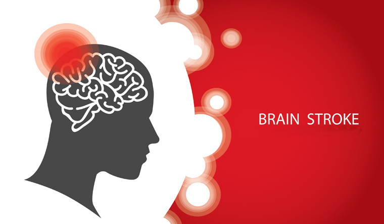 Over 60 new genetic regions behind stroke identified, may lead to new ...