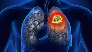 Over 32,000 Cancer Cases Reported In Recent Years In Jammu And Kashmir ...